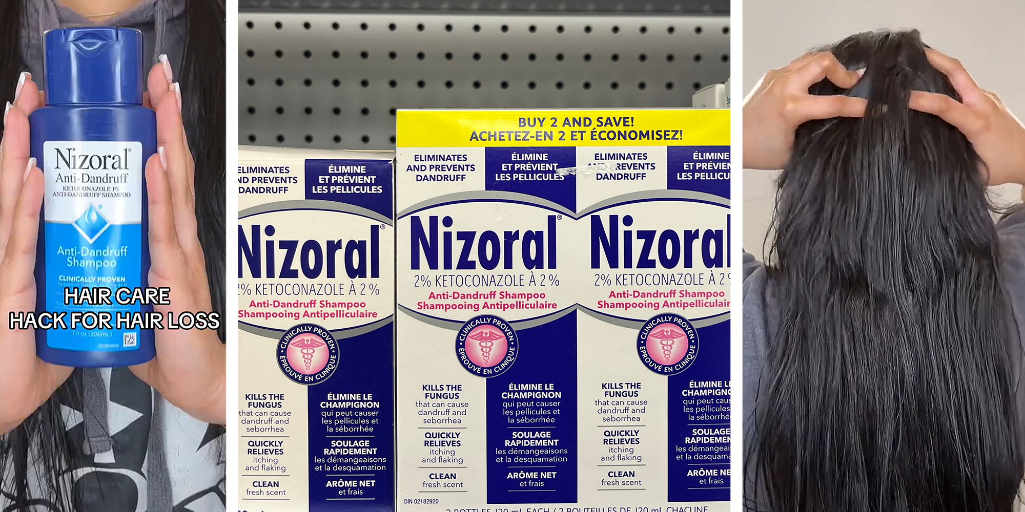 Can Nizoral Anti-Dandruff Shampoo Treat Hair Loss?
