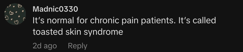 Woman using heating pad nightly reveals "toasted skin syndrome"