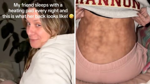 Woman using heating pad nightly reveals "toasted skin syndrome"