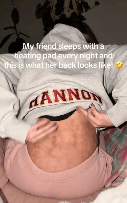 Woman using heating pad nightly reveals "toasted skin syndrome"