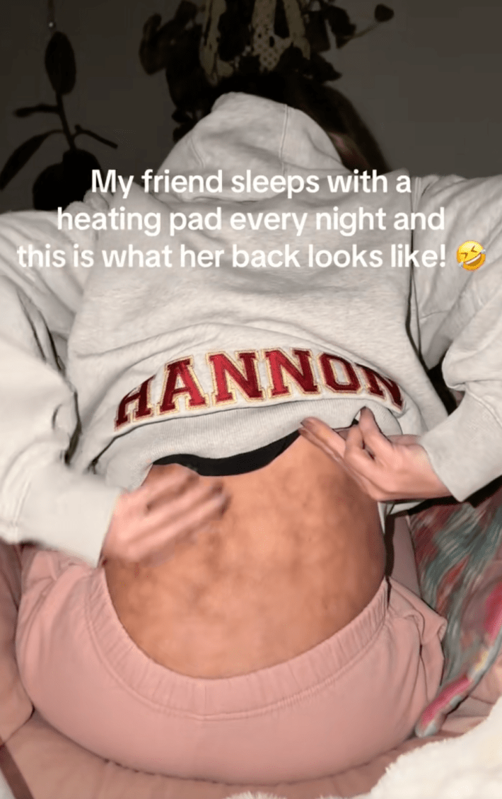 Woman using heating pad nightly reveals "toasted skin syndrome"