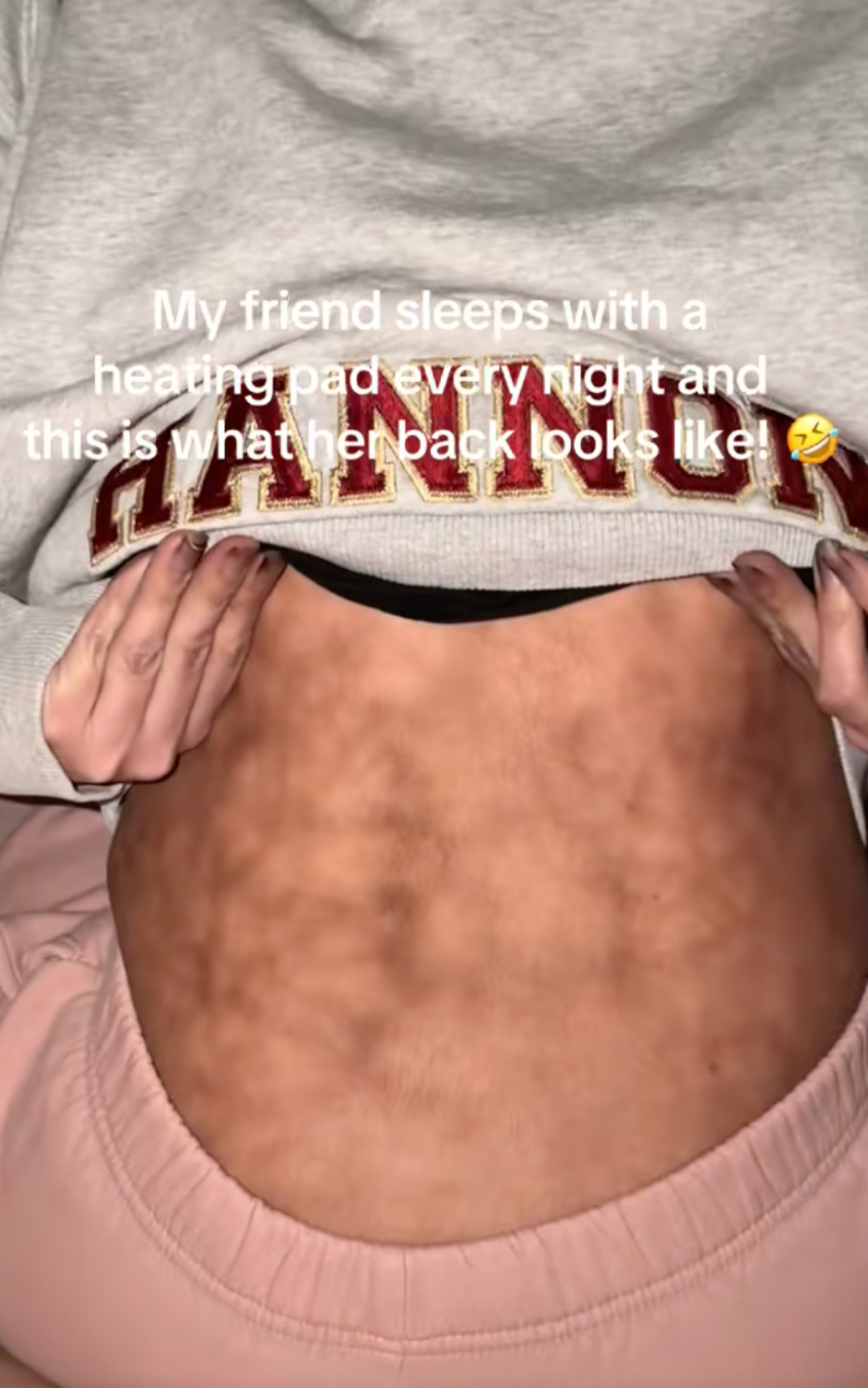Woman using heating pad nightly reveals "toasted skin syndrome"